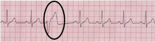 EKG Rhythm Quiz Questions - ProProfs Quiz