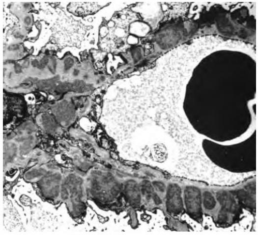 nephrotube-online-quiz-membranous-nephropathy-proprofs-quiz