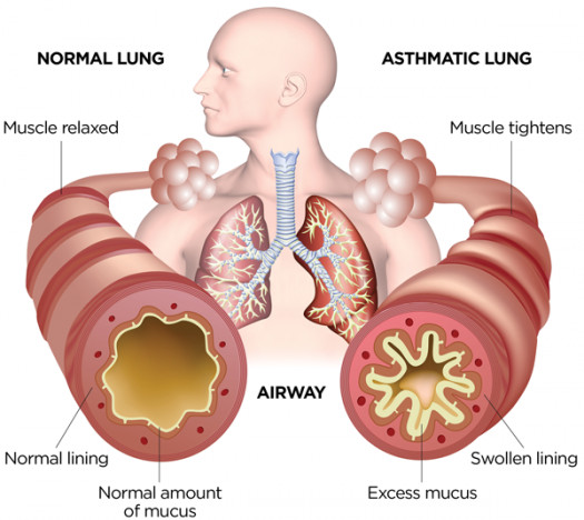 Test Quiz Pharmacotherapy Of Asthma ProProfs Quiz